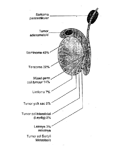 Materi Kesehatan: Kanker Testis